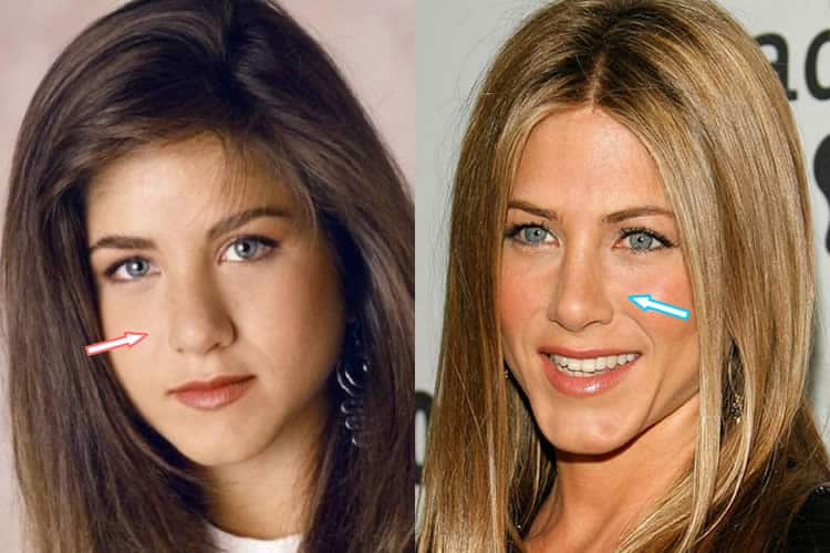 Has Jennifer Aniston Had Plastic Surgery? (Before & After 2018) Has Jennifer Aniston Had Plastic Surgery? (Before & After 2018)
