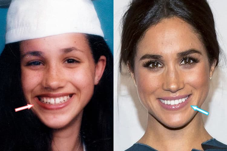 Has Meghan Markle Had Plastic Surgery? (Before & After 2022) Has Meghan Markle Had Plastic Surgery? (Before & After 2022)