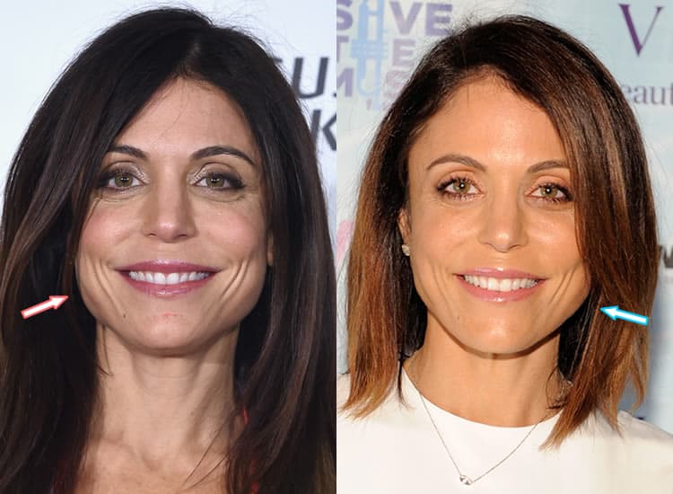 Does Bethenny Frankel Have Cosmetic Surgery? Does Bethenny Frankel Have Cosmetic Surgery?