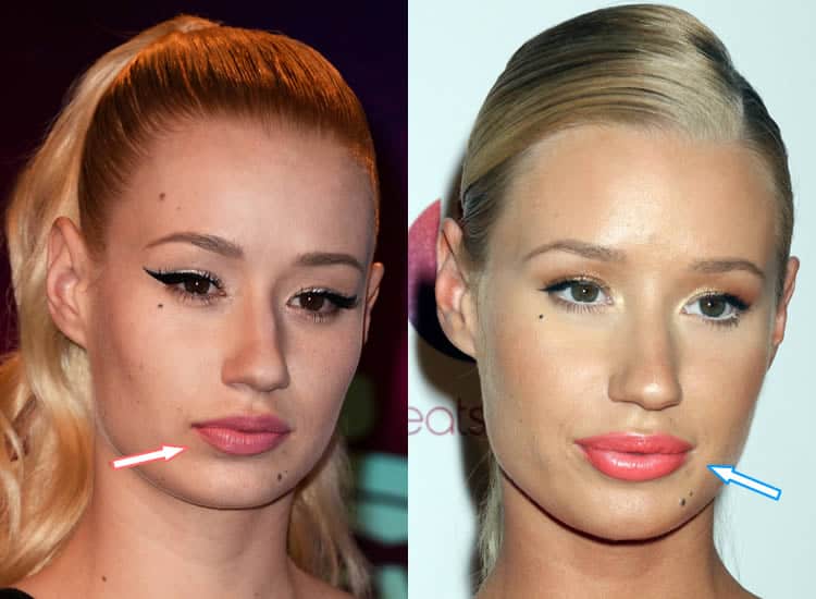 Iggy Azalea Plastic Surgery EXPLAINED! (Before & After 2021) Iggy Azalea Plastic Surgery EXPLAINED! (Before & After 2021)