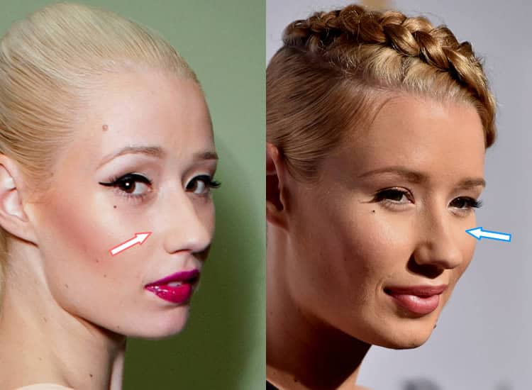 Iggy Azalea Plastic Surgery EXPLAINED! (Before & After 2021) Iggy Azalea Plastic Surgery EXPLAINED! (Before & After 2021)