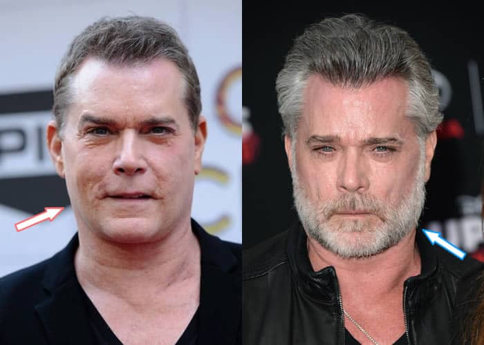 Ray Liotta Plastic Surgery - Facelift, Botox & Hair Transplant?