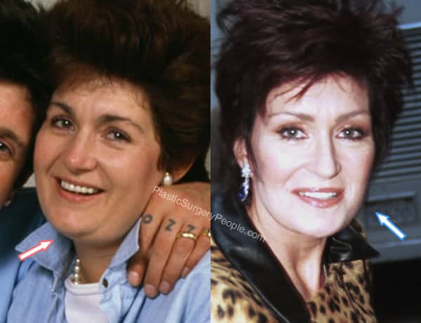 Sharon Osbourne: BEFORE and AFTER
