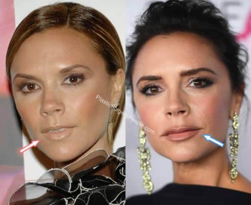 Victoria Beckham, BEFORE and AFTER 2022